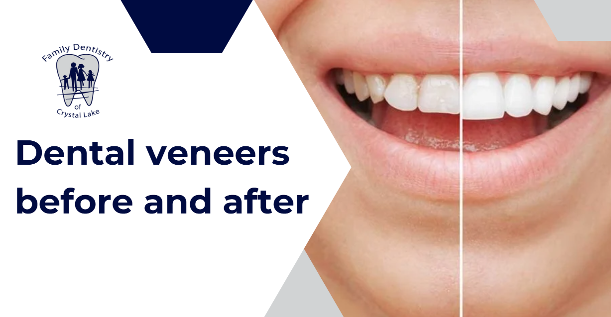 How Veneers Enhance Your Teeth for a Flawless Look - Family Dentistry
